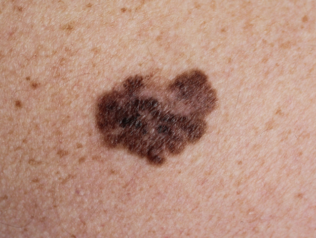 Melanoma - Skin Health Institute