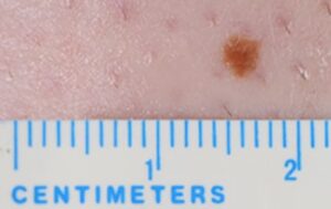 How to check your skin - Skin Health Institute