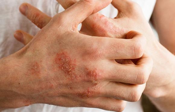 Atopic Dermatitis - Skin Health Institute