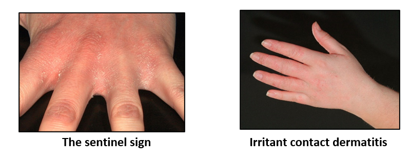 Section 2.1 Irritant Contact Dermatitis - Skin Health Institute