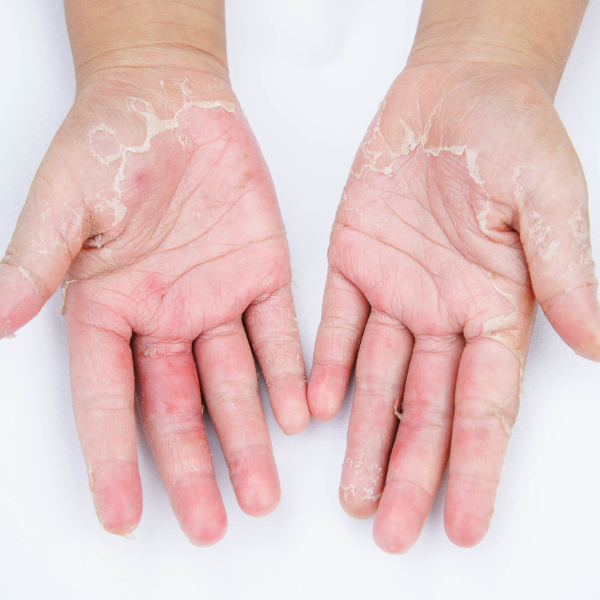 Clinical Treatment Series - Contact Dermatitis - Skin Health Institute